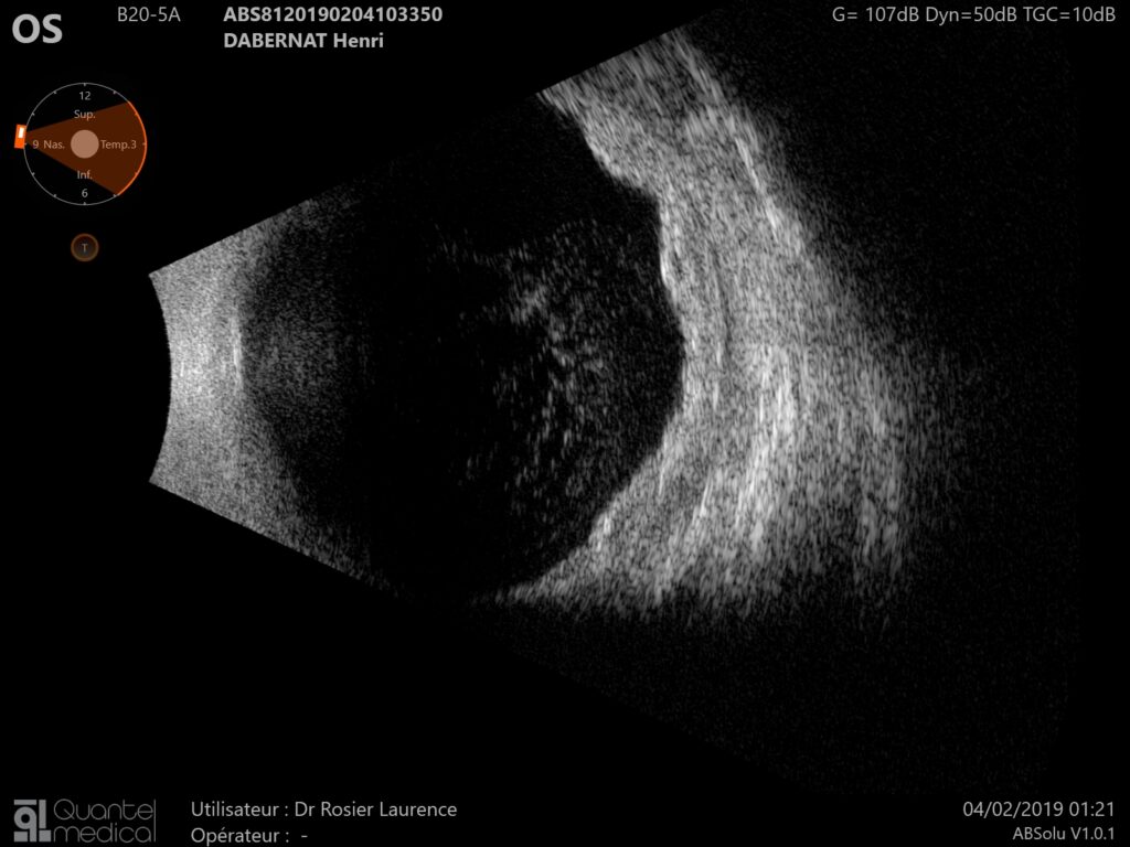 Quantel ABSOLU – VisionCare Limited